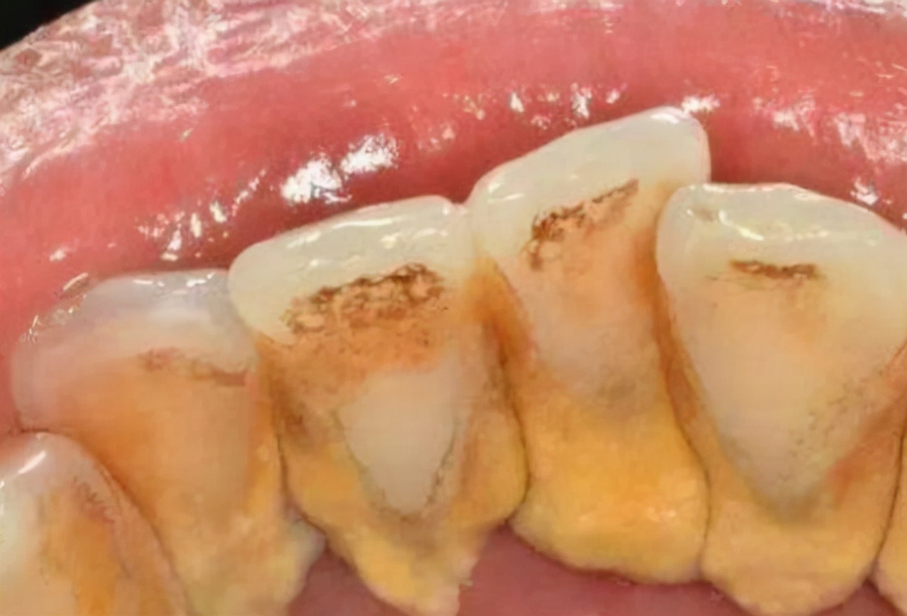 Can "dental calculus" be digged out by myself?Teach you a trick, the ...