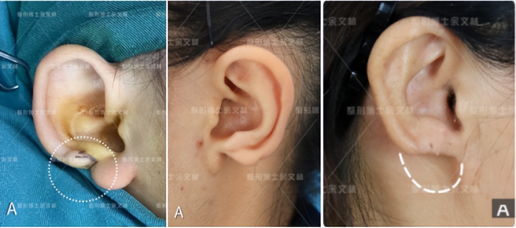 How can earlobe repair be performed for earlobe defect and earlobe ...