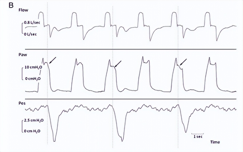 Professor Luo Hong: How to identify "reverse trigger" during mechanical ...
