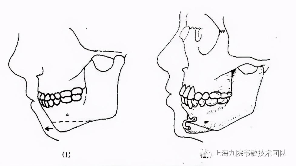 How to distinguish between a short chin and a receding chin? - iMedia