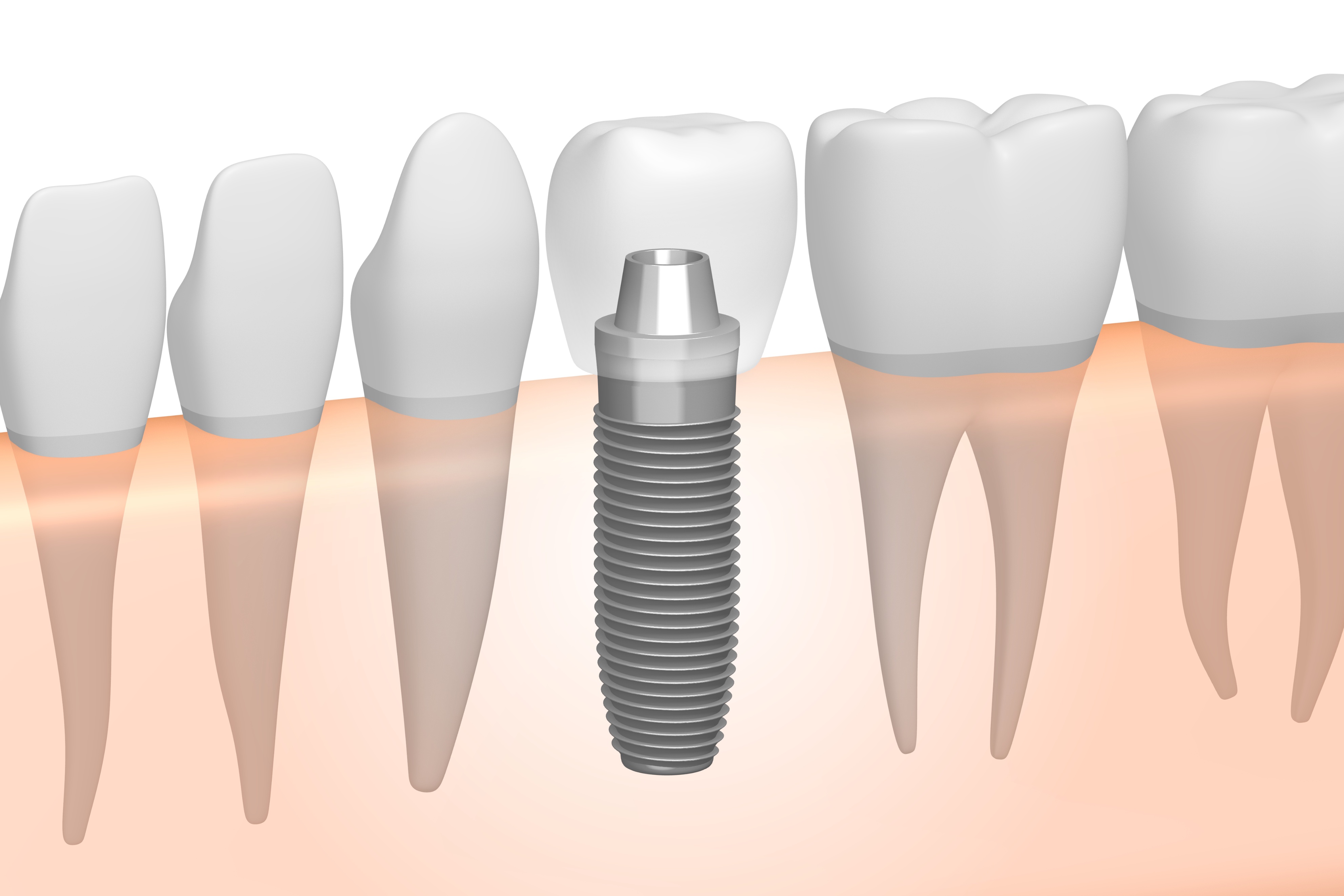 The lifespan of dental implants is shortened because of it! ! - Peri ...