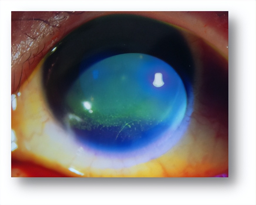 Prof. Gong Lan: Clinical features and treatment strategies of corneal ...