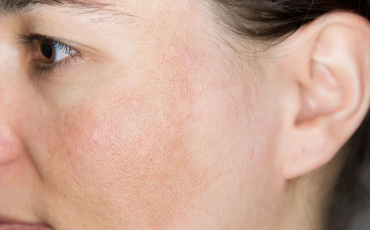 Don't panic if you have chloasma during menopause, try these methods ...