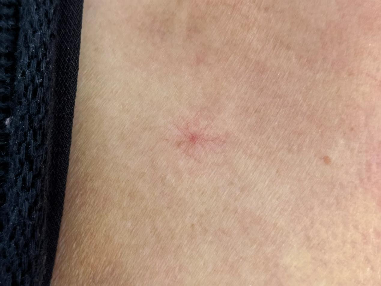 Typical clinical signs of liver cirrhosis—recognizing liver palms and ...