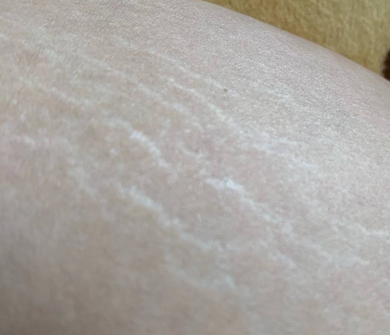 Can obesity stretch marks be saved?How should the fat lines that are ...