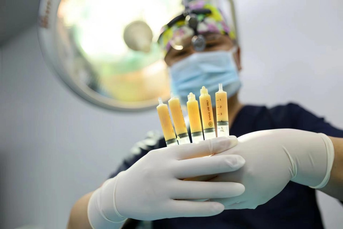 Significance of preparing nanofat: wide application and remarkable ...