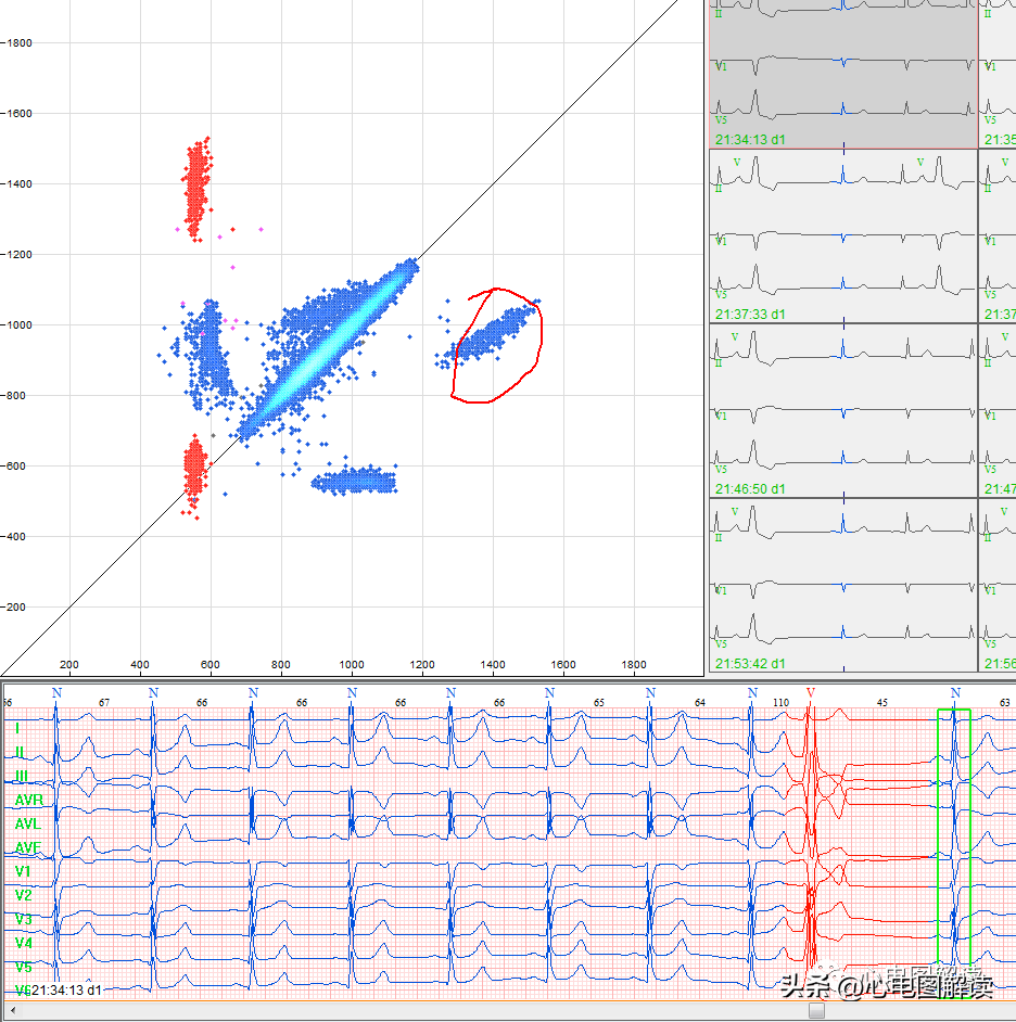Premature ventricular contractions with fully compensated ...