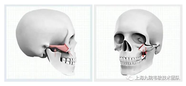 Does cheekbone push-in cause facial sagging? - iNEWS