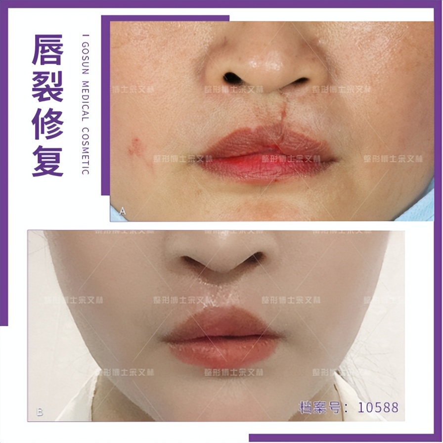 How to deal with the scar left after cleft lip repair? - iNEWS
