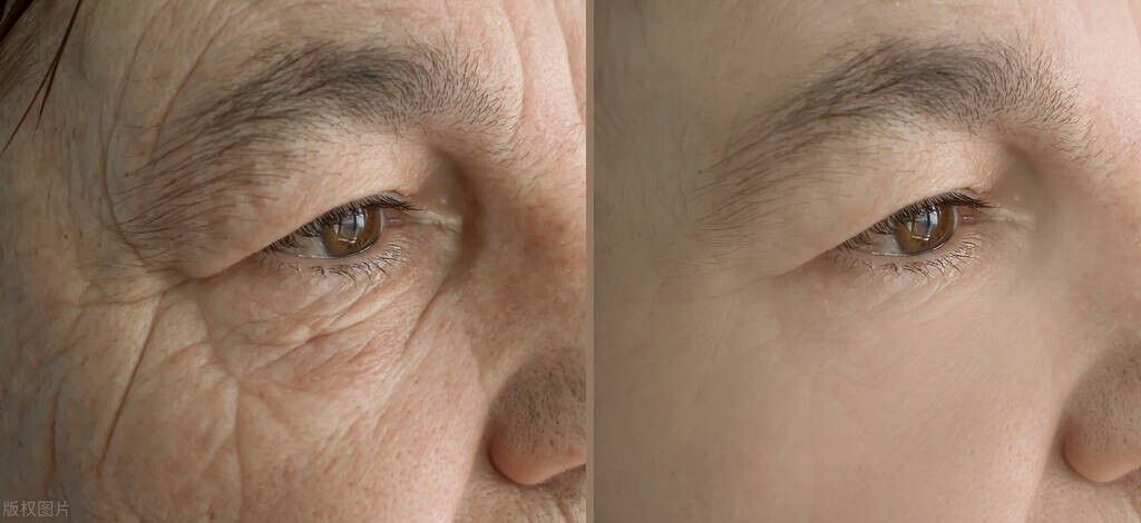 What is the cause of drooping eyelids in the elderly? what to do? - iNEWS