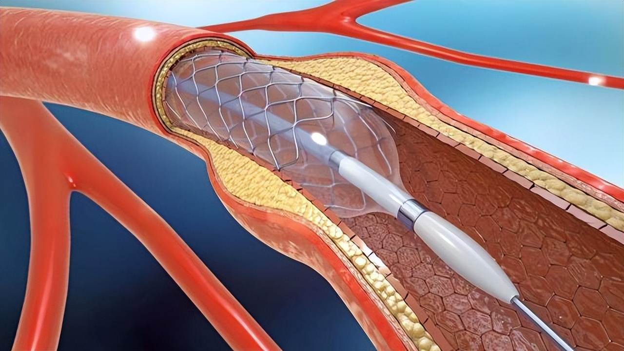Cardiac stent surgery belongs to "immoral harm", and it's over when it ...