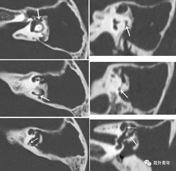 Common Abnormal Temporal Bone CT Summary - iNEWS