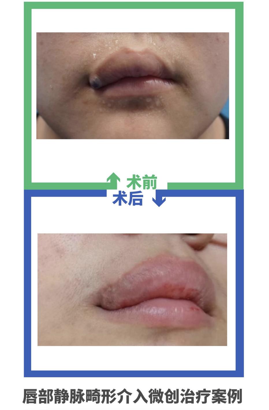 Child's labial venous malformation cured after interventional minimally ...
