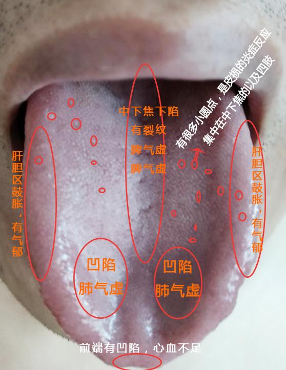 What are the typical characteristics of both qi and blood deficiency ...