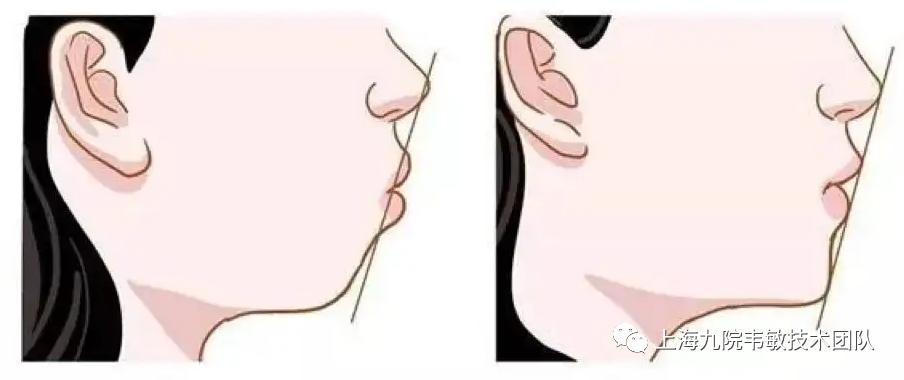 Why is there no clear dividing line between the chin and the neck? - iNEWS