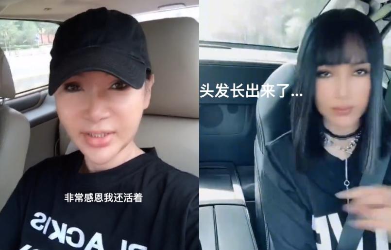 Singer Zhang Mi basked in the anti-cancer process, the skin on her face ...
