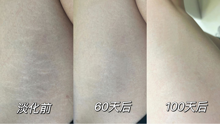 100 days to record the disappearance of fat lines!Listen to my advice ...