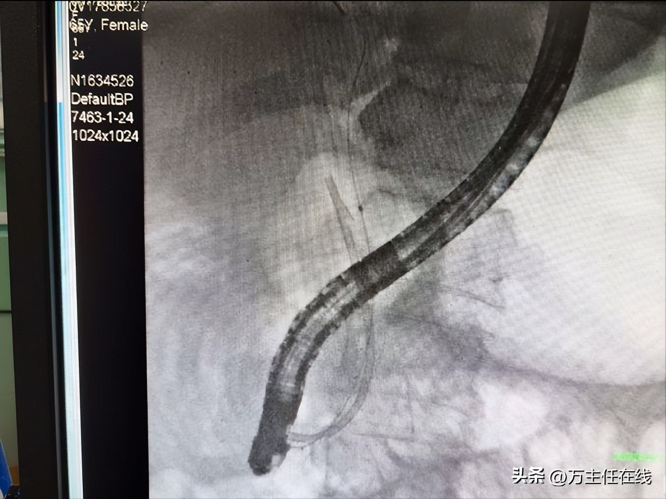 Professor Yi Wanrong from Shanghai successfully relieved a patient with ...