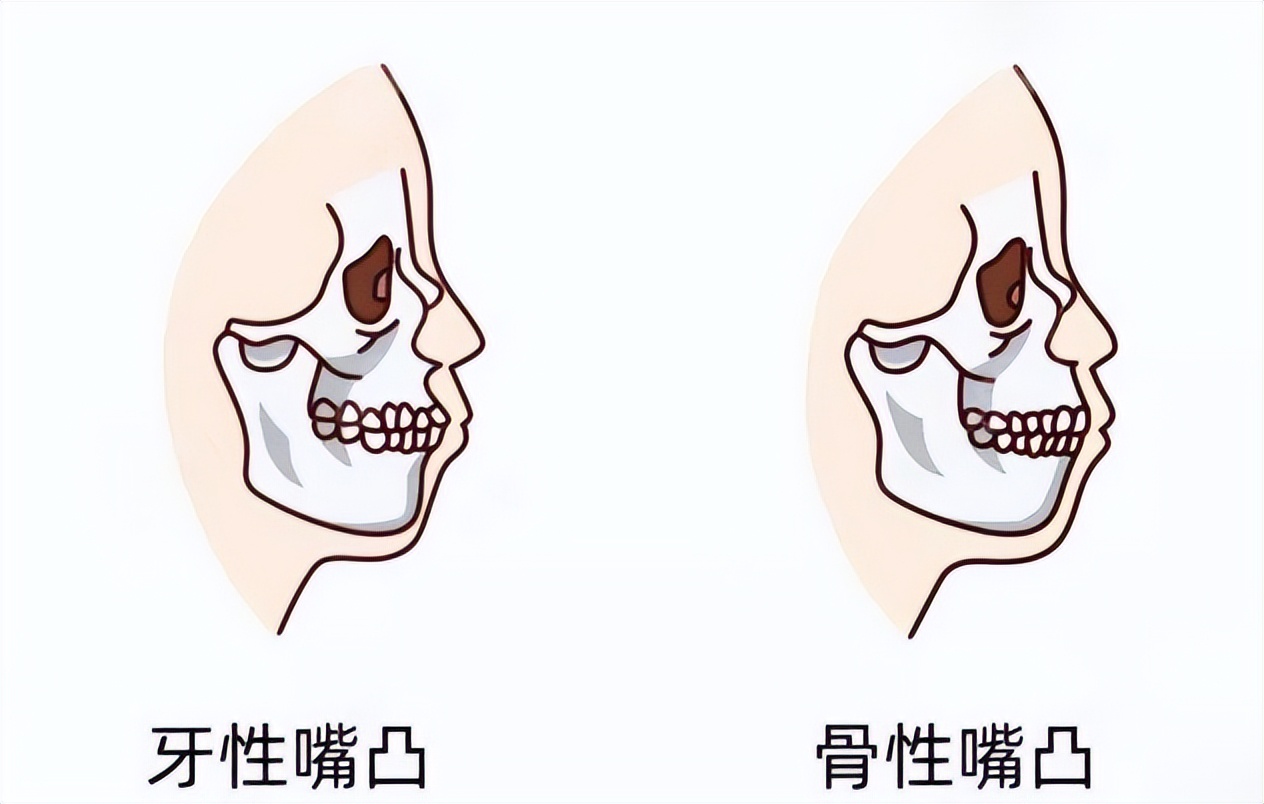 What is the cause of mouth protrusion? - iNEWS