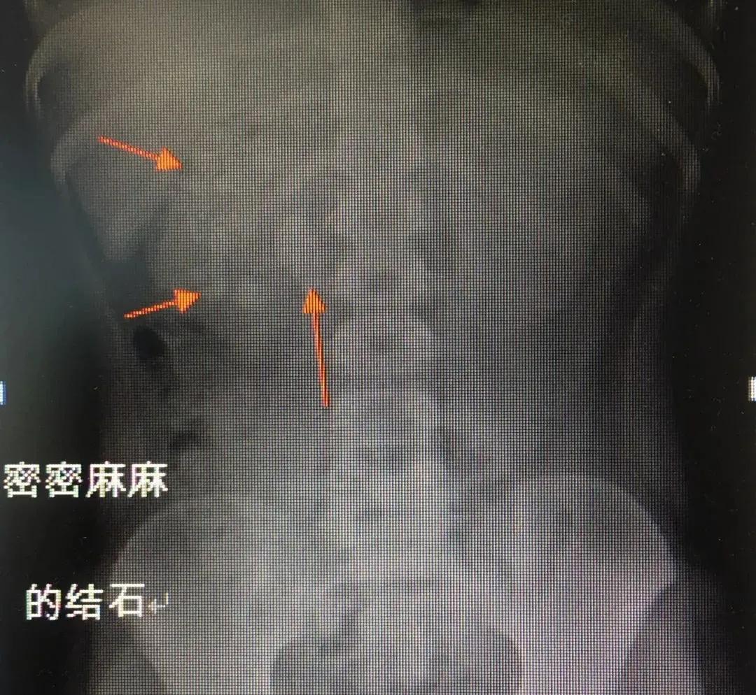 56 stones in a 9-year-old boy, this bad habit, see if your child has ...