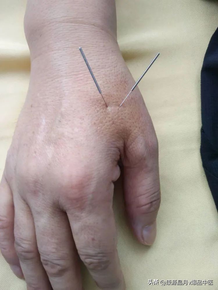 Acupuncture for hand dysfunction after stroke (collector's edition) - iNEWS