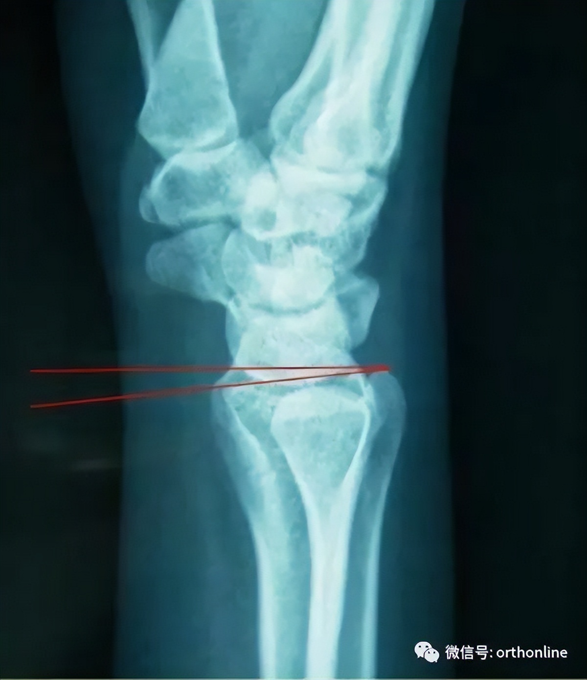 Closed reduction and fixation of distal radius fractures - iNEWS