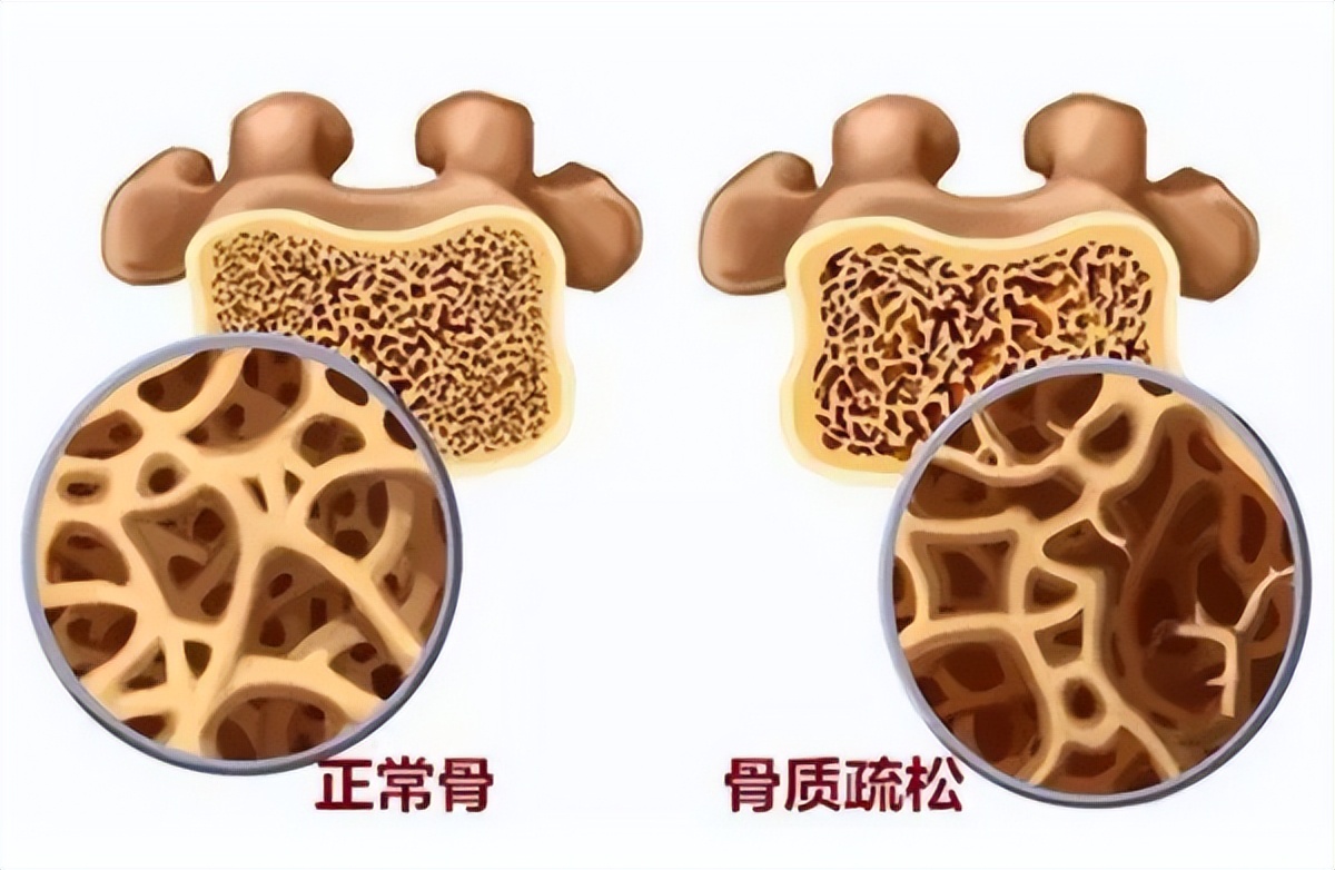 How does two cigarettes a day affect your bones? - iMedia