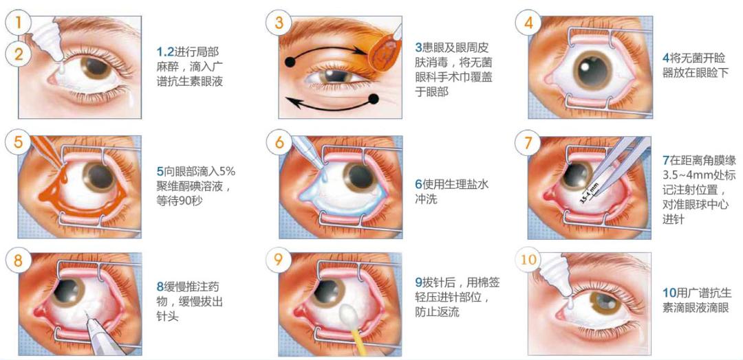 What diseases can be treated with intraocular injections? Make it clear ...