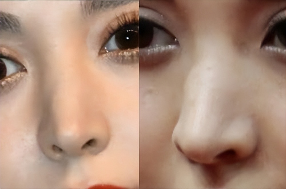 Failed rhinoplasty actress: Guli Nazha! - iMedia