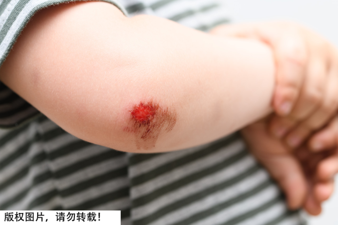 Why is the scab so itchy?The more you pull the top?hurry up... - iNEWS