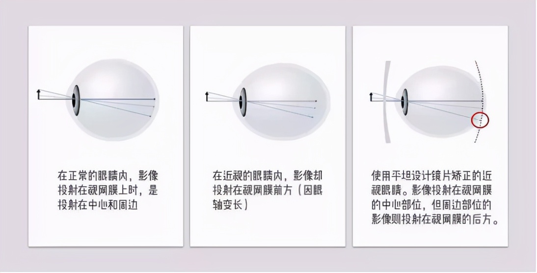 Atropine, OK mirror, vision training, lowering mirror, massage and ...