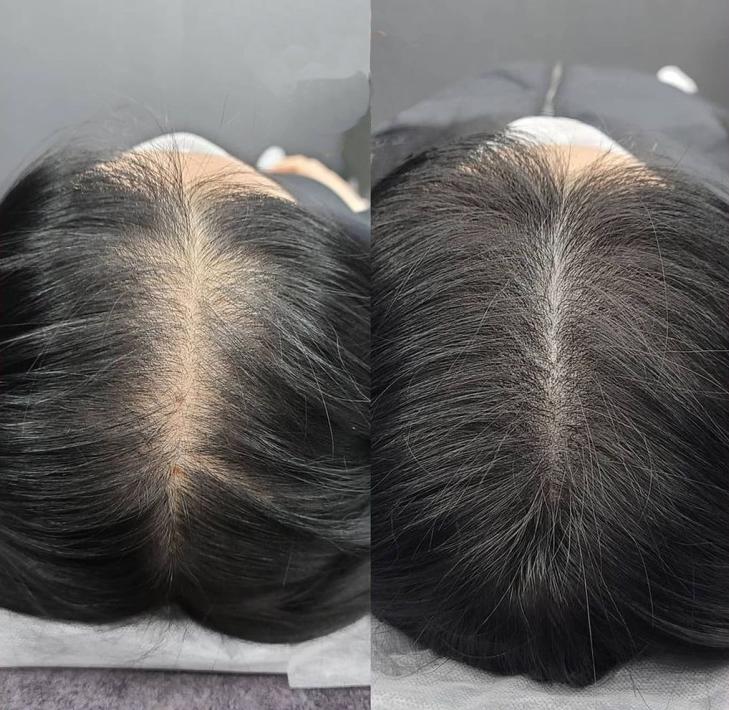 Hair loss treatment new technology, 100 days to grow thick hair again ...