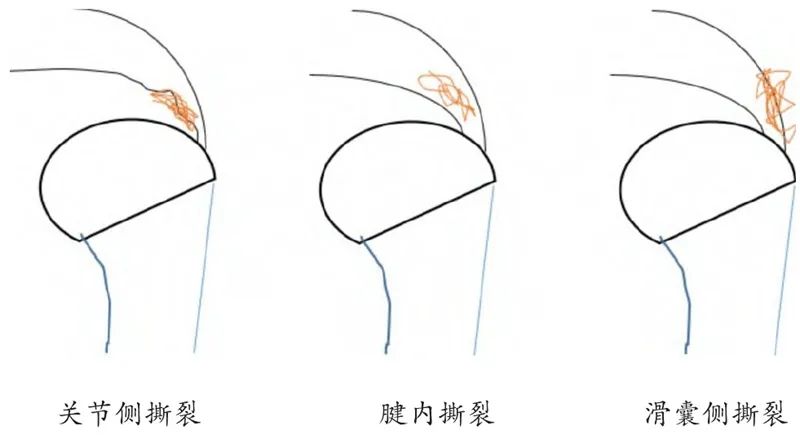 Diagnosis and treatment of partial rotator cuff injuries - iNEWS