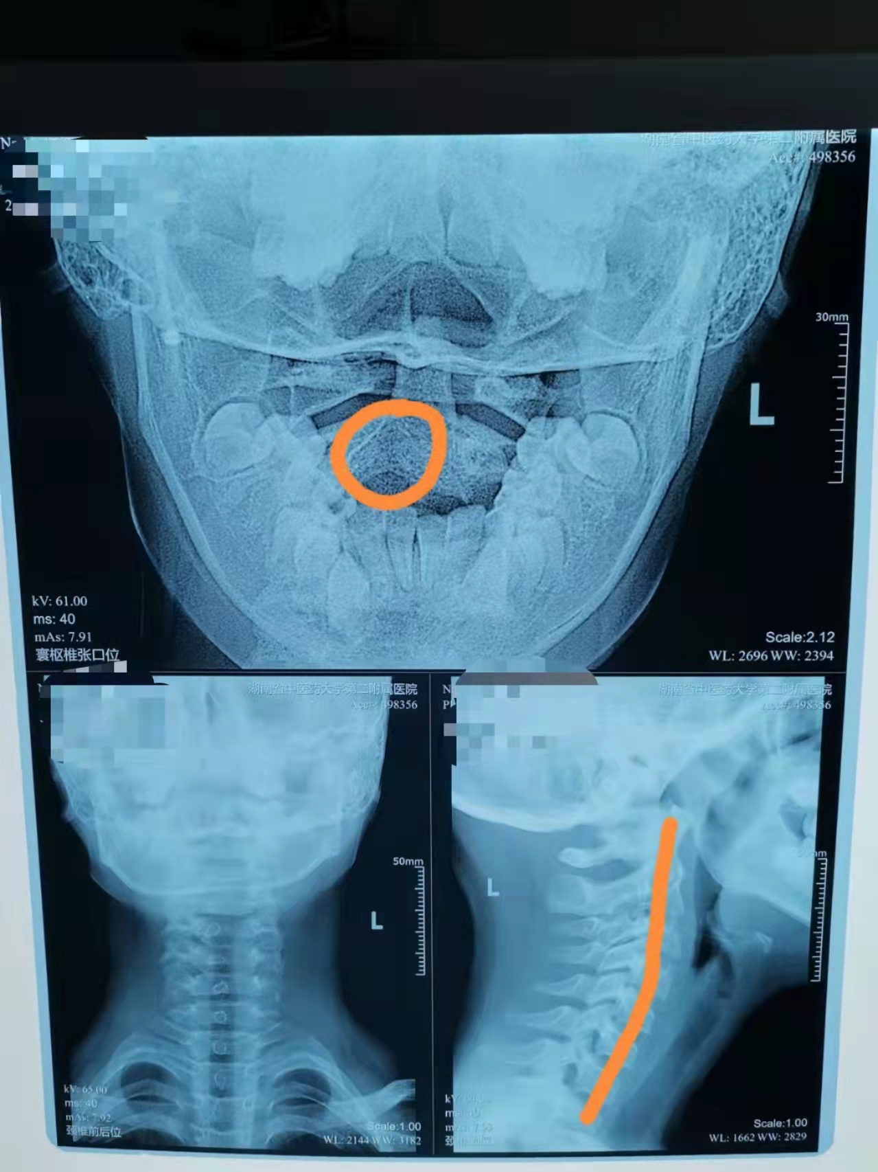 Neck discomfort in children, often twisting - iNEWS