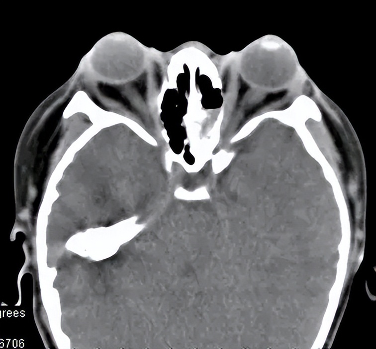 What is Crouzon syndrome (Crouzon disease)? - iNEWS