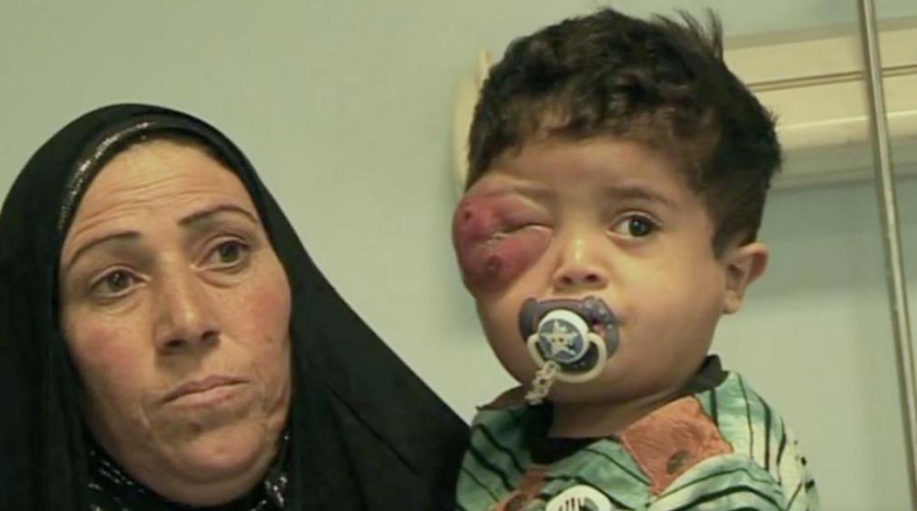 20 years later, the "scars" of Iraq were uncovered again, and Kiev must ...