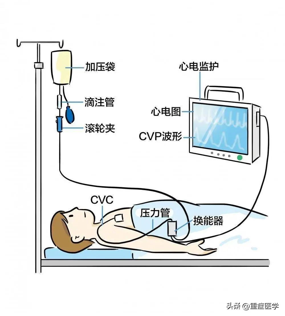 Is central venous pressure mmHg or cmH2O? Do you know? - iNEWS