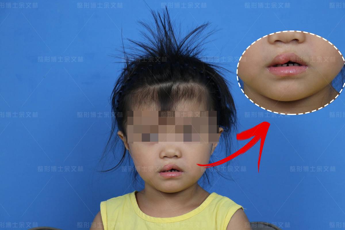 What should I do if a piece of lips is missing after Cleft Lip Repair ...