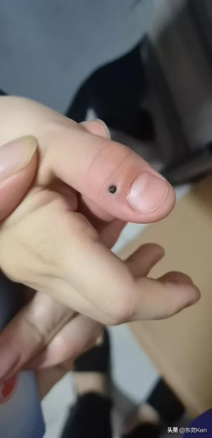 Will the pencil lead stuck in your hand cause harm to your body? - iNEWS
