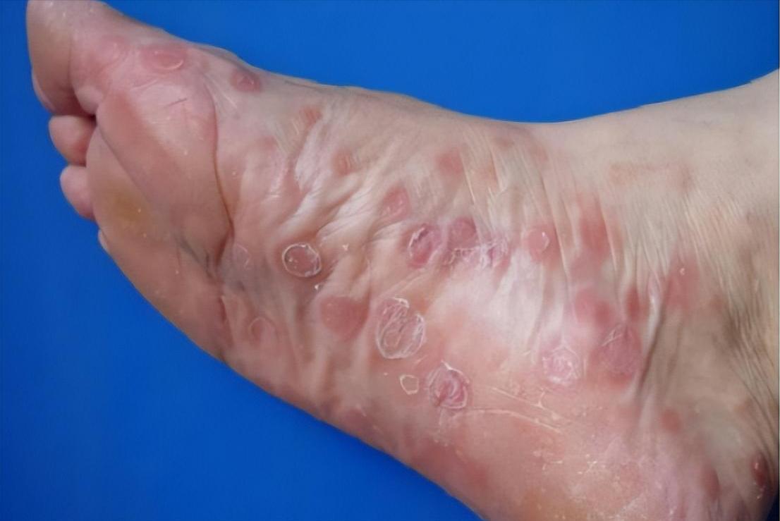 Typical performance of syphilitic feet! Most people think that they ...