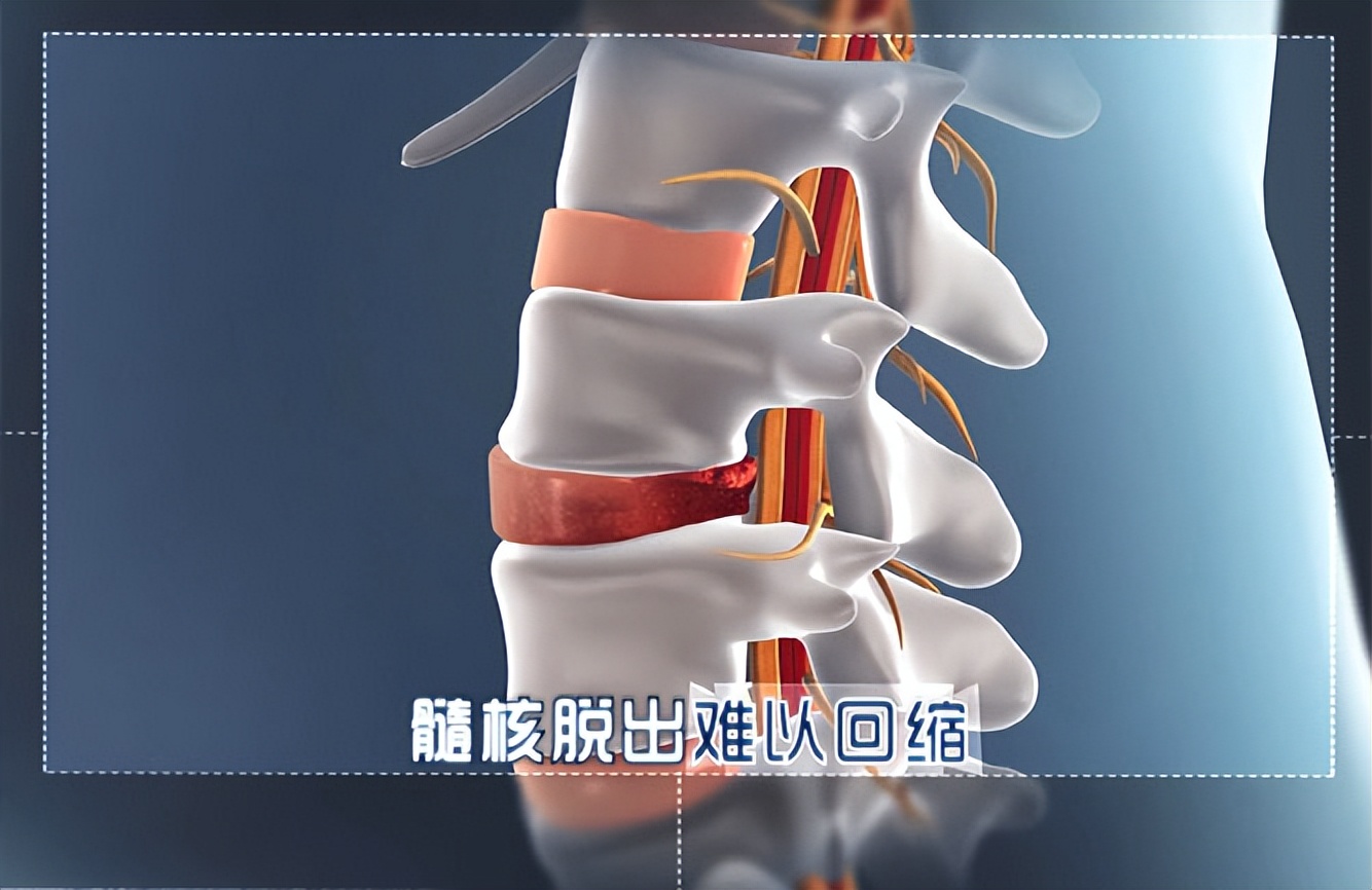 Do you really understand the treatment of lumbar disc herniation with ...