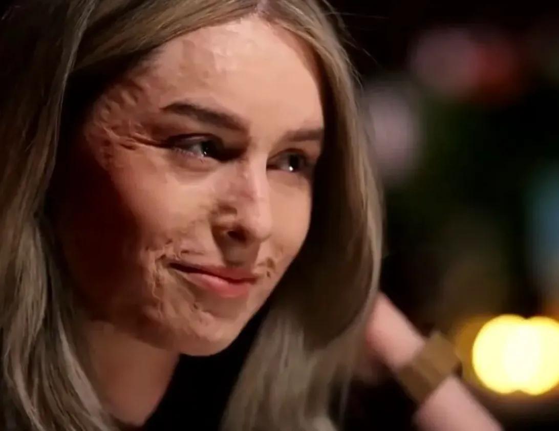 The woman who survived the volcanic eruption survived, 70% burned, and ...