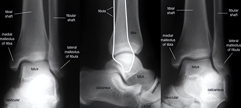 Why do I keep "scarring my feet"?Beware of ankle lateral collateral ...