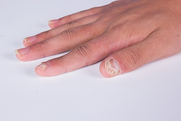 Nail gray is not necessarily equal to nail fungus! What is the real ...