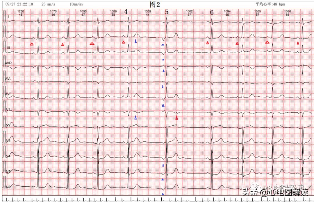 Long RR interval and its effects: atrial premature failure, junctional ...