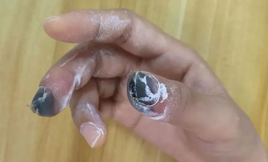 In addition to burns and scalds, what other diseases can the burn department see? - iNEWS