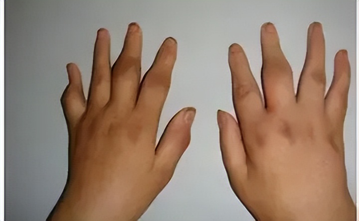 Beware of rheumatism when you are sore all over the body on rainy days ...