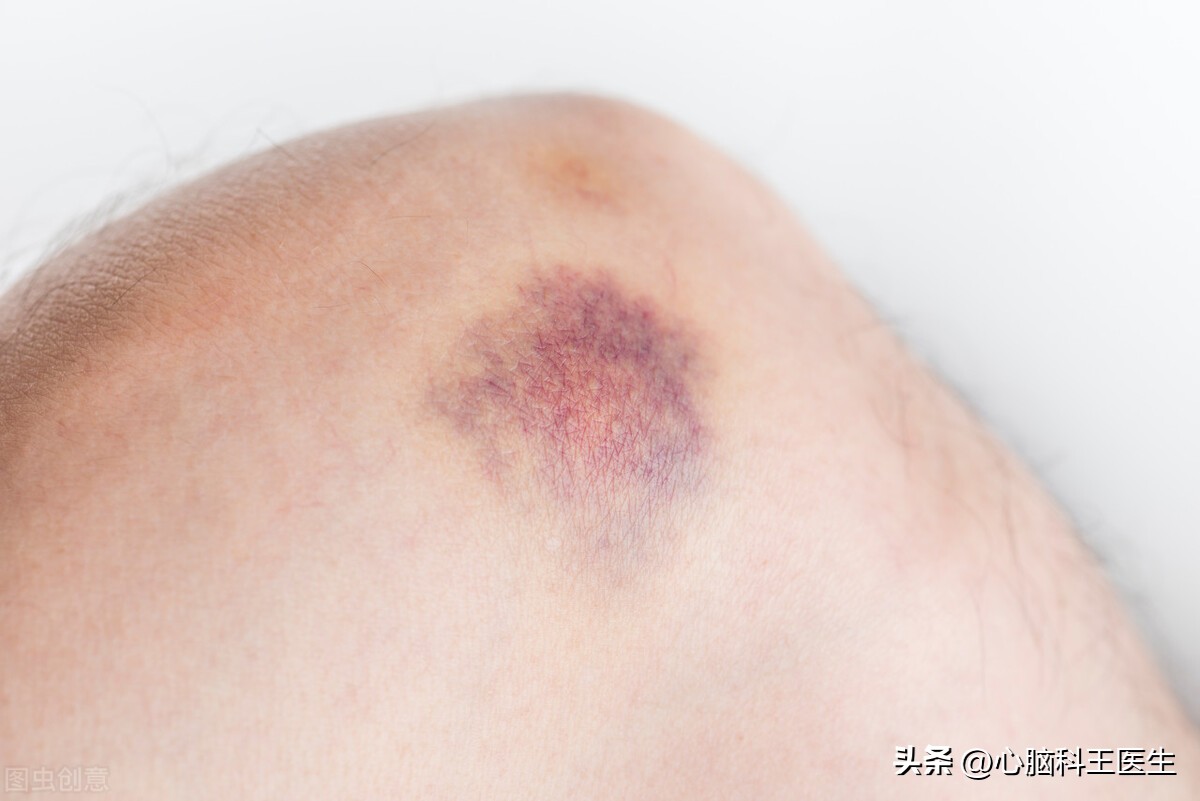 Bleeding caused by taking aspirin, should I stop taking aspirin?Doctor ...