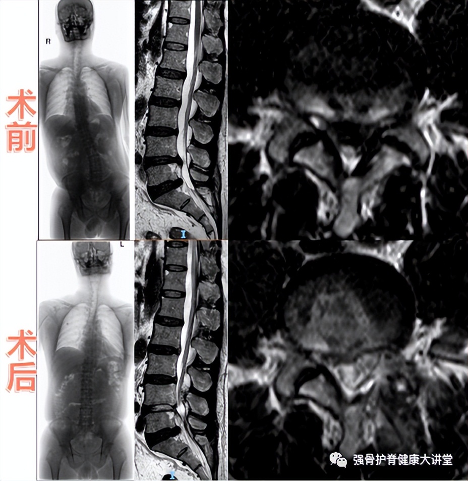 "Case Sharing" Lumbar protrusion patient with scoliosis recovers ...