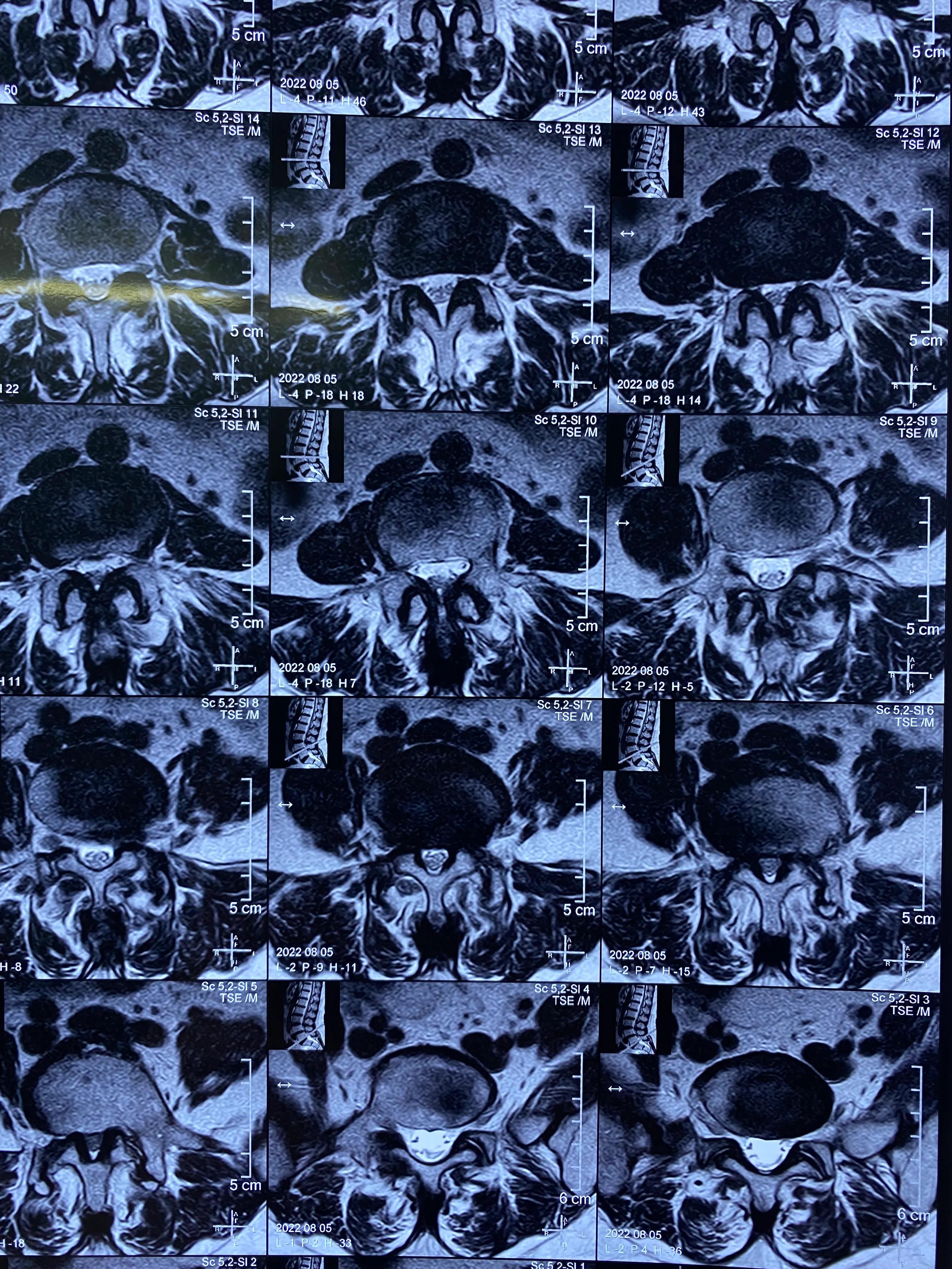 MRI, CT and ordinary film to see the popular analogy of bananas - iNEWS